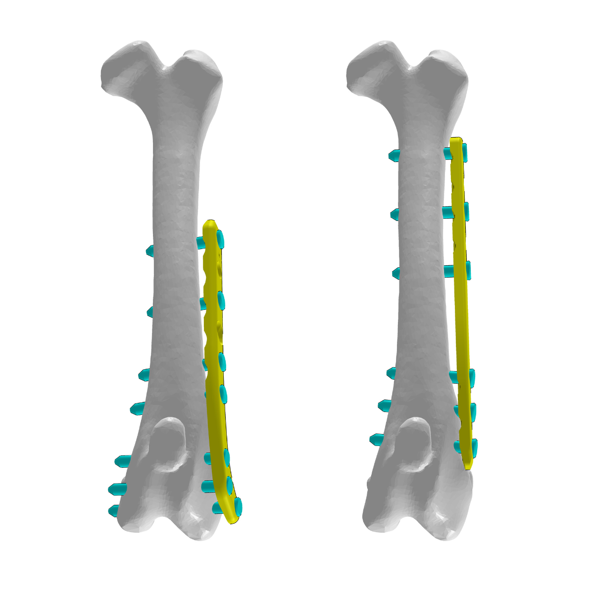 Taller de Resolución de Fracturas Avanzado